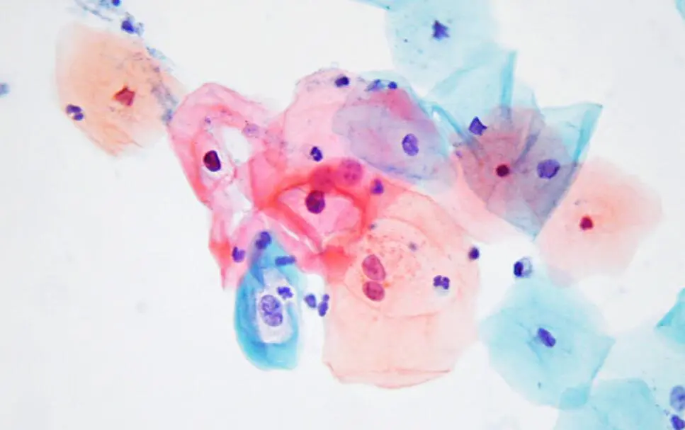 What Are The Vaginal Cancer Smell Like? | Gynin